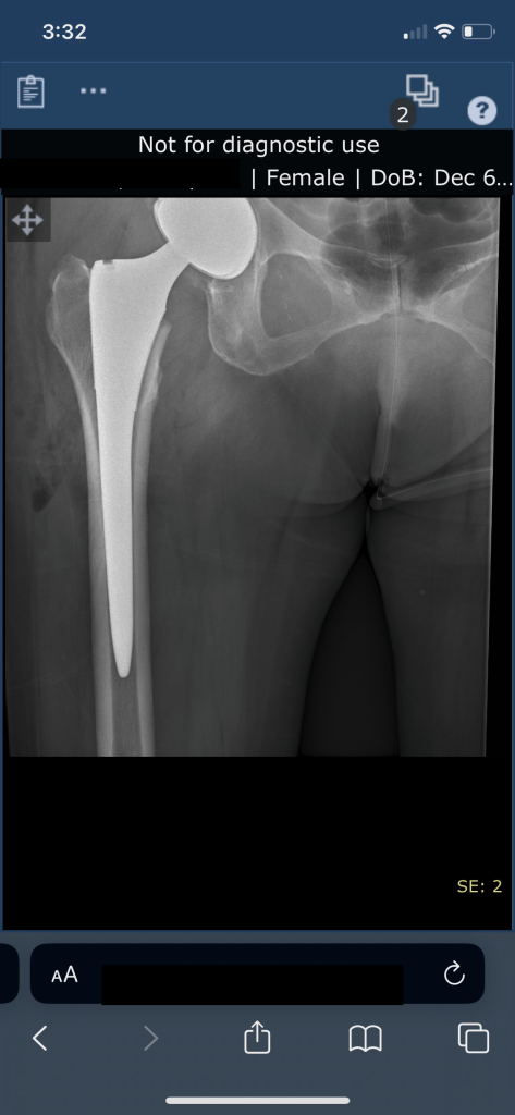 Open Reduction and Internal Fixation (ORIF) Surgery in Florida Personal ...