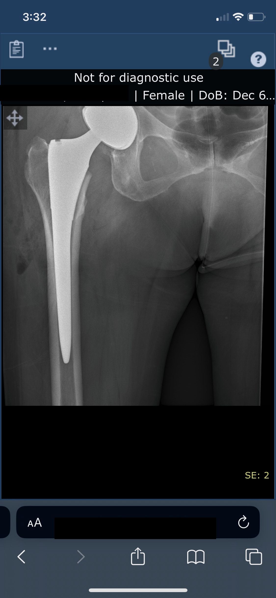 Open Reduction and Internal Fixation (ORIF) Surgery in Florida Personal ...